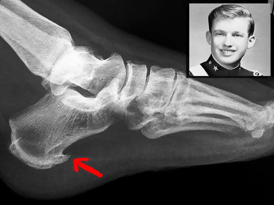 Trump's Bone Spurs Refute President's Claims He'd Run Into Mass ...